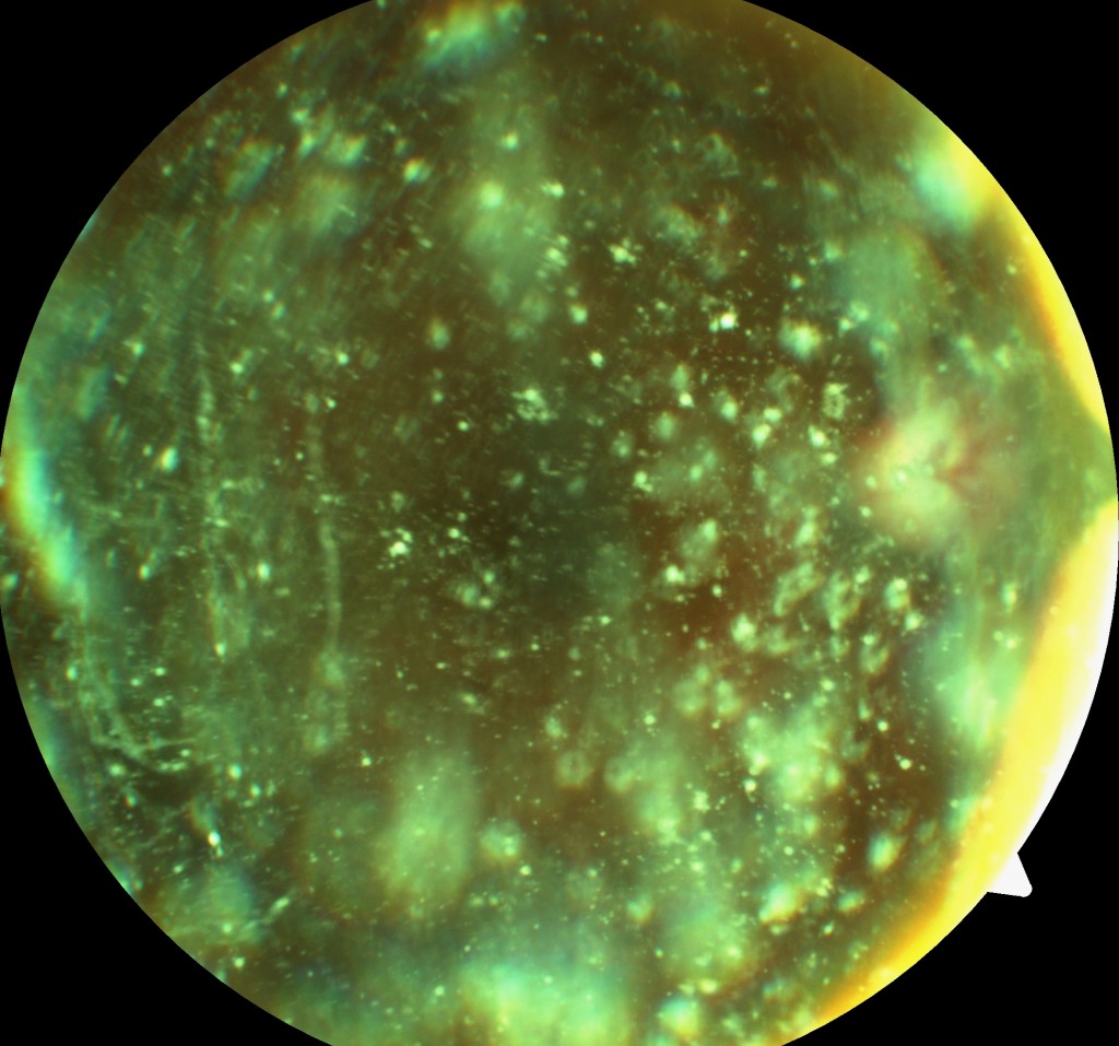 Asteroid Hyalosis – the retina vault